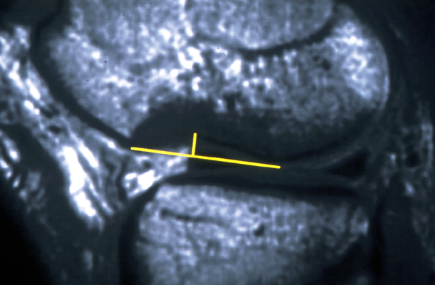 Deep Lateral Femoral Notch Sign